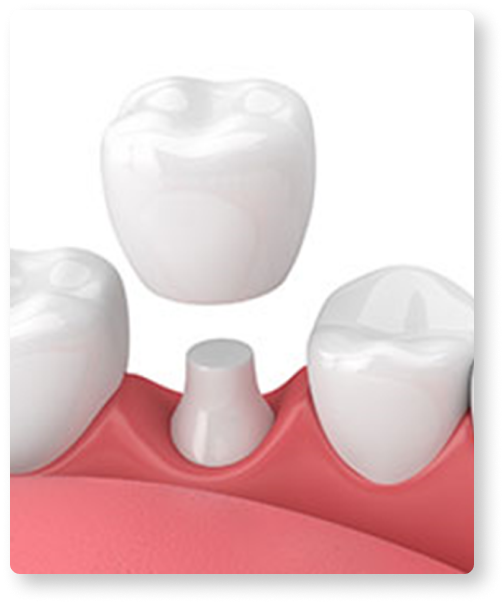 Crowns - First Smile Pediatric Dentistry